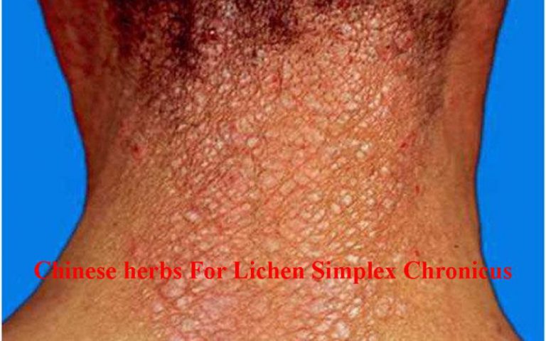 Using Chinese herbs treat Lichen Simplex Chronicus (LSC) - TCM Houston ...